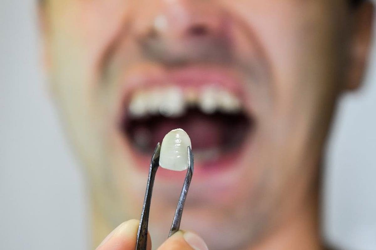 Missing Teeth | Restorative Dentistry | Chislehurst | Bromley | Kent